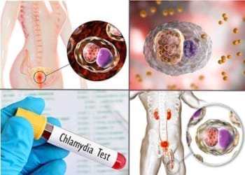 Chlamydia: Causes, Symptoms, Treatment & Prevention - Doctor Zara