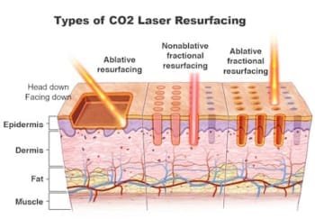 Carbon Dioxide (CO2) Laser Resurfacing Treatment: Benefits, Side ...