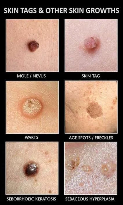 What are Skin Tags and Everything About Skin Tag Removal - Doctor Zara