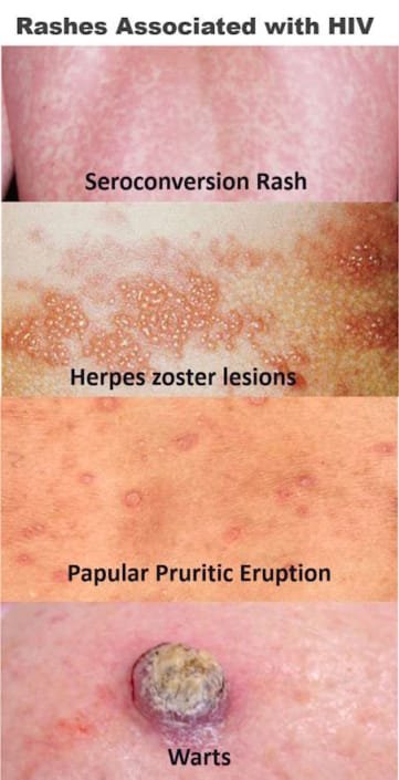 How to Identify HIV Rash: Pictures & Treatment - Doctor Zara