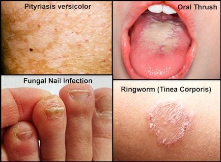 Fungal Infection: Types, Causes & Treatments - Doctor Zara