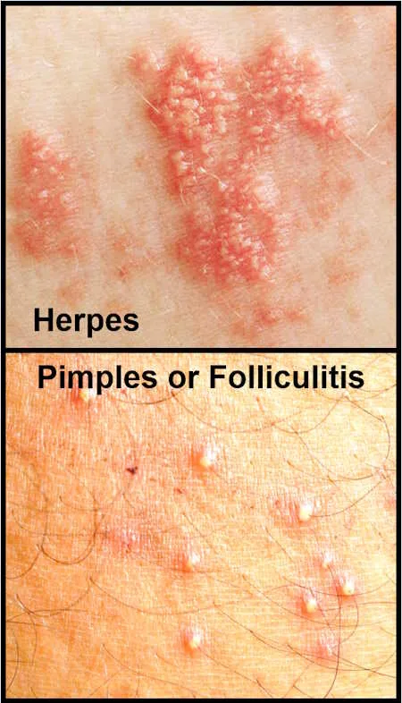 Herpetic Folliculitis
