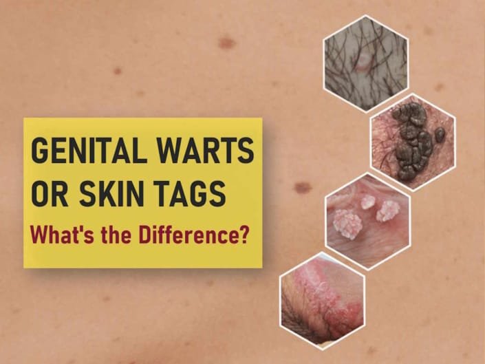 Genital Warts (HPV) Vs. Skin Tags: What's the Difference? - Doctor Zara