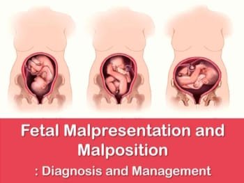 Fetal Malpresentation and Malposition: Diagnosis and Management - Doctor Zara