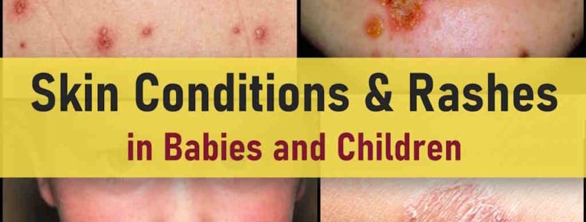 Common Skin Conditions & Rashes in Babies and Children - Doctor Zara