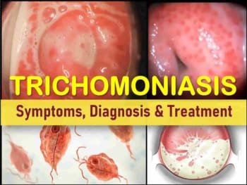 Trichomoniasis (Trich): Causes, Symptoms, Diagnosis & Treatment ...