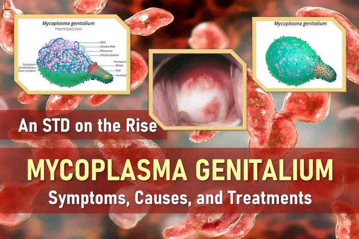 Mycoplasma Genitalium (Mgen): Symptoms, Causes & Treatment - Doctor Zara