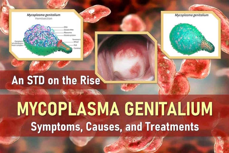 Mycoplasma Genitalium (Mgen): Symptoms, Causes & Treatment - Doctor Zara