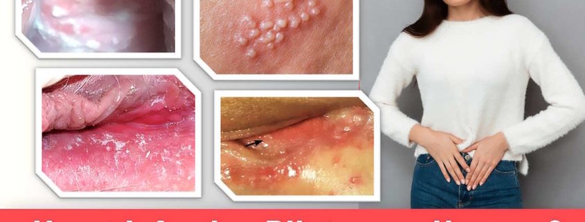 Yeast Infection Vs Herpes Bumps Herpes Gladiatorum | Wisconsin